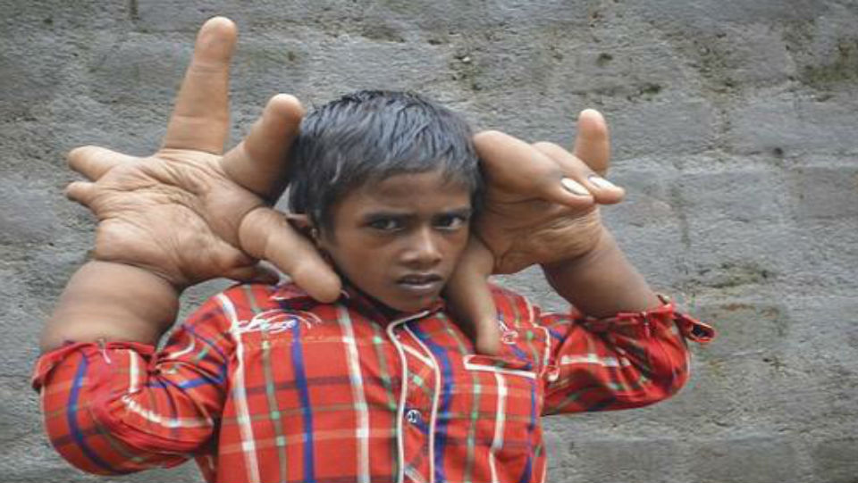 Un niño con manos gigantes desconcierta a los médicos en India