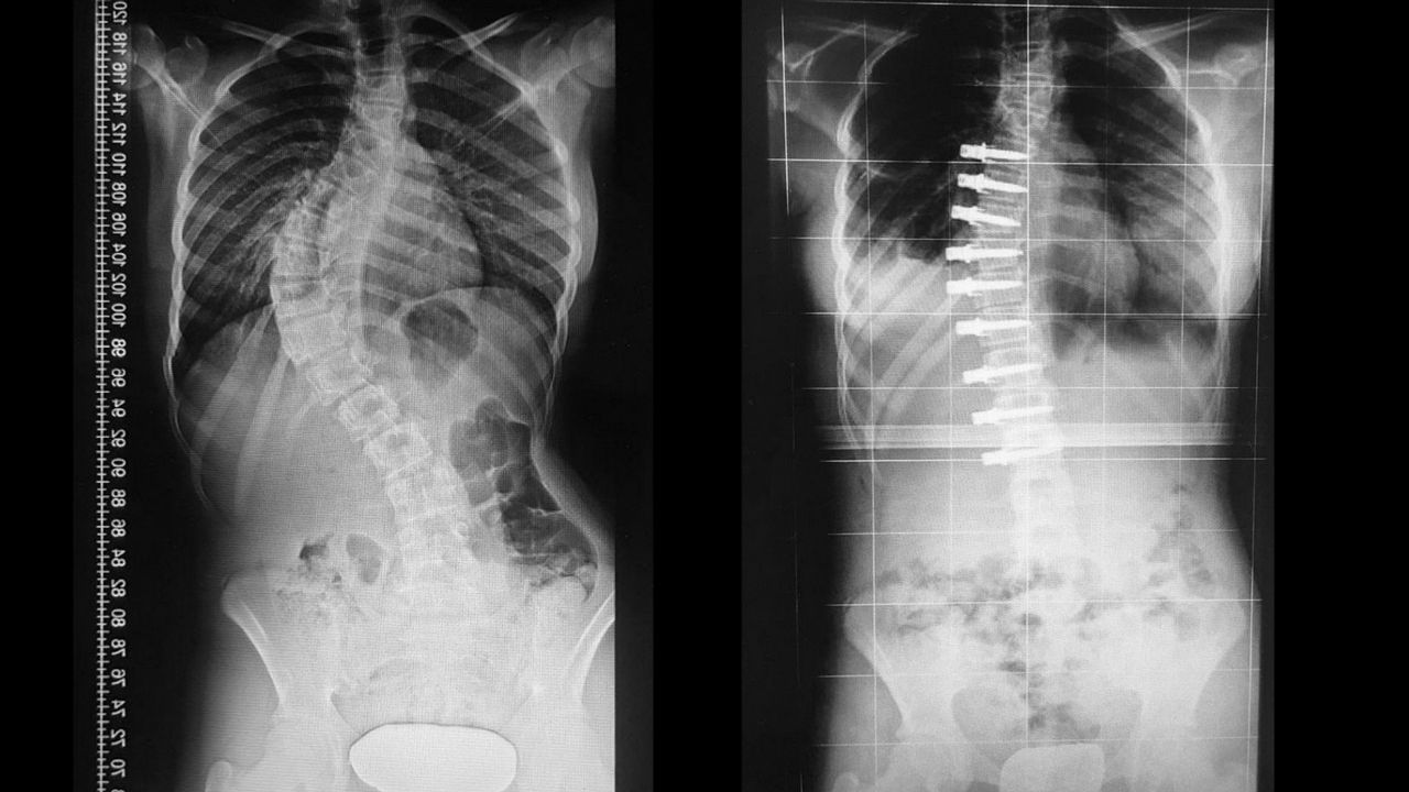 Una técnica pionera corrige la desviación de columna actuando desde el ...