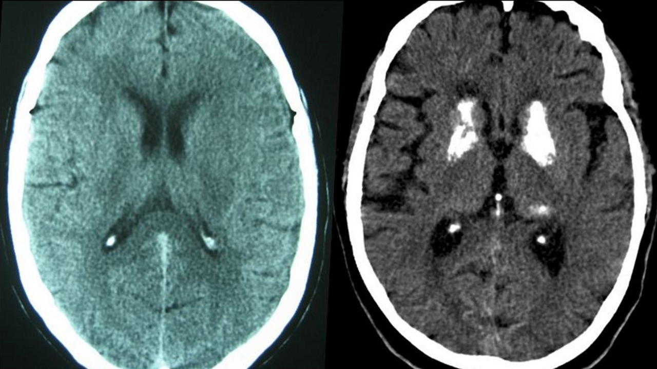 El trauma medular agudo es una enfermedad rara
