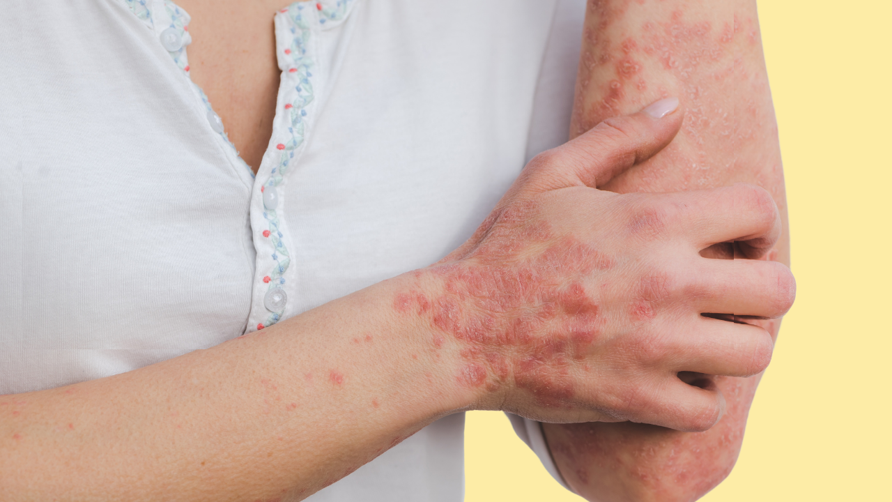 La vida con psoriasis: «Cuando no saben nada de esta patología, me ...