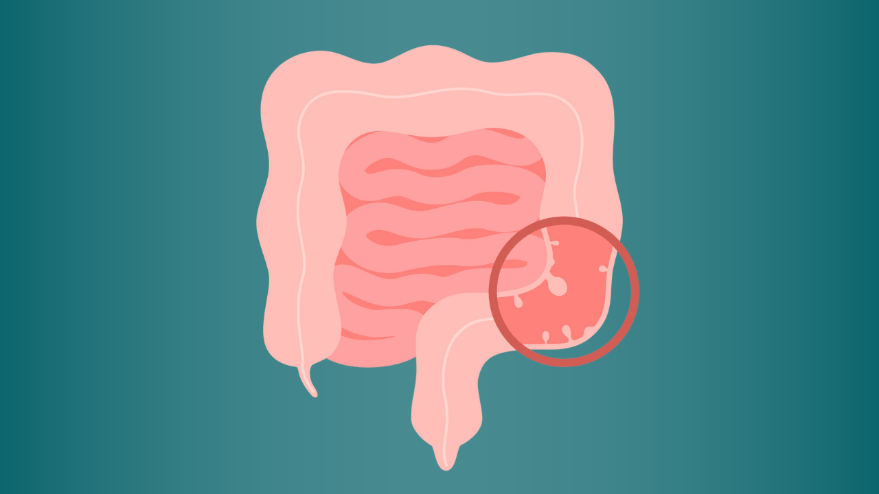 ¿En qué consiste el cribado de cáncer de colon? Así se buscan lesiones ...