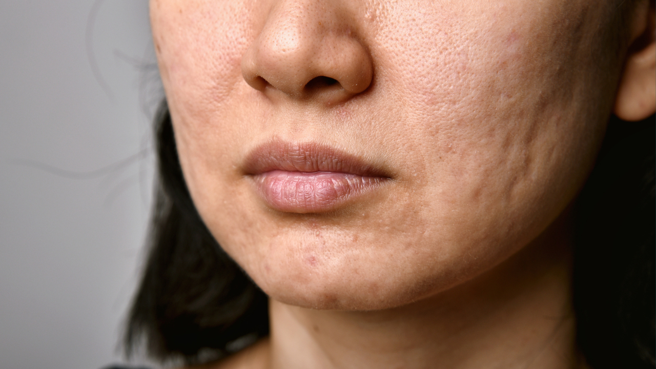 Cicatrices: ¿qué tipos existen?, ¿se pueden eliminar?